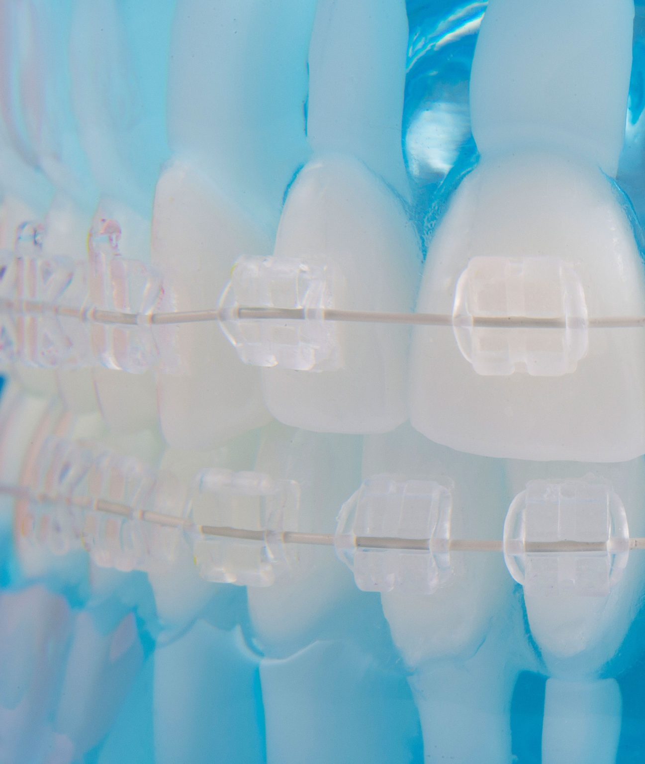 Clear Bracket - Orthobasics